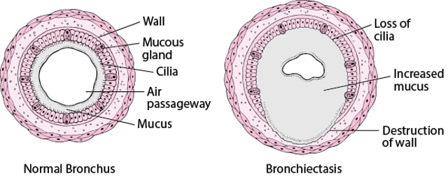 Bronchiectasis - Lung and Airway Disorders - MSD Manual Consumer Version