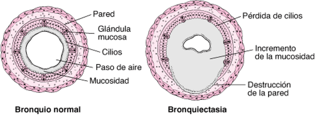 Bronquiectasia Trastornos Del Pulmón Y Las Vías Respiratorias