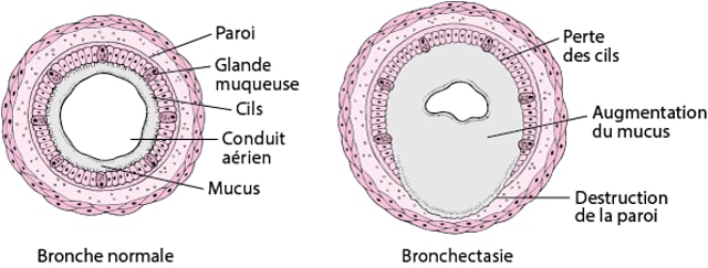 Bronchectasie - Troubles pulmonaires et des voies aériennes - Manuels ...