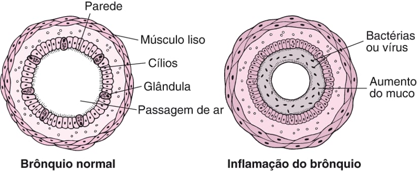 Bronquite aguda - Distúrbios pulmonares e das vias respiratórias ...