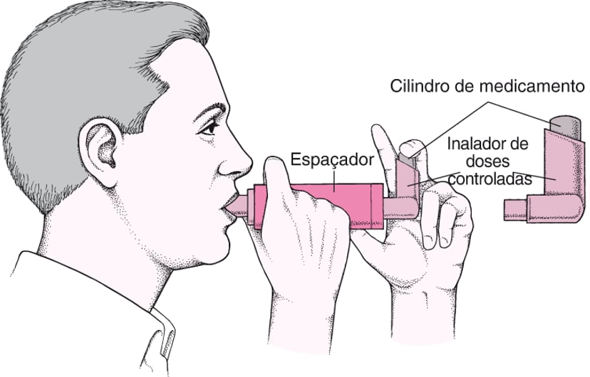 Asma em crianças - Problemas de saúde infantil - Manual MSD Versão ...