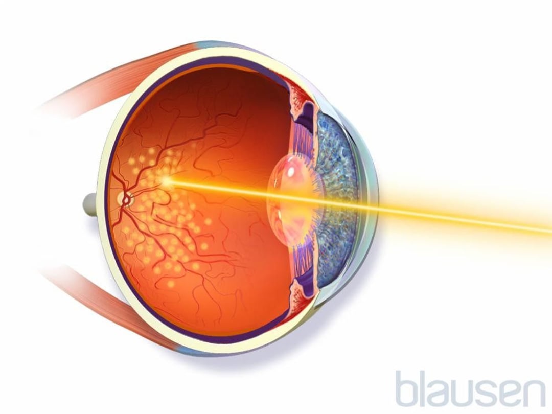 Retinopati Diabetik - Gangguan Mata - Manual MSD Versi Konsumen