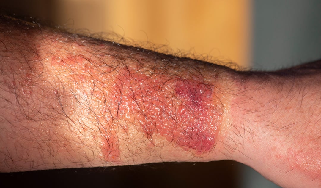Photosensitivity Reactions - Skin Disorders - Merck Manual Consumer Version