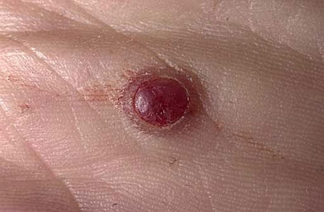 Granuloma Piogenik - Gangguan Kulit - Manual MSD Versi Konsumen
