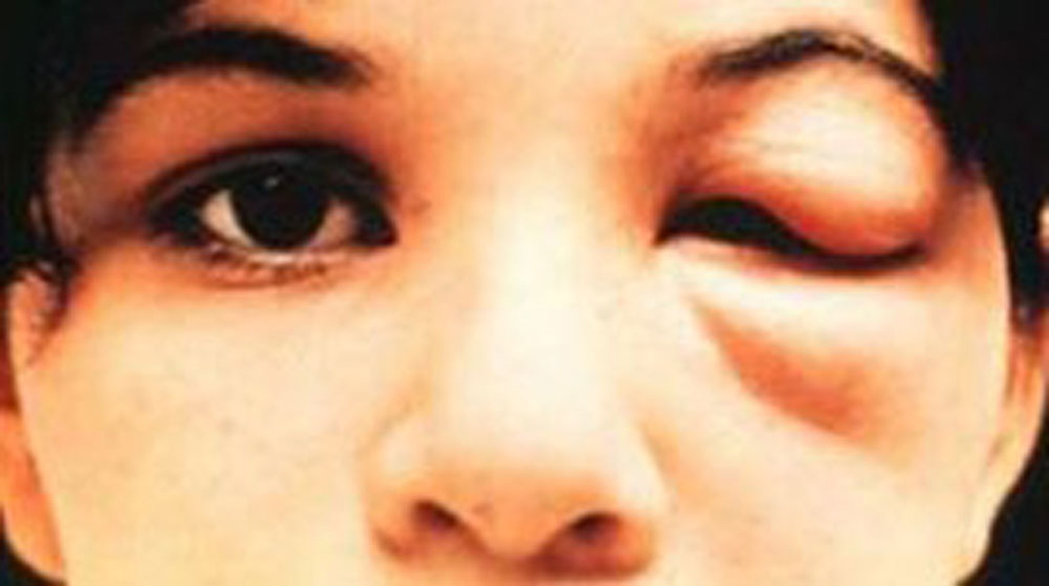 Image:Romaña Sign-Merck Manual Consumer Version