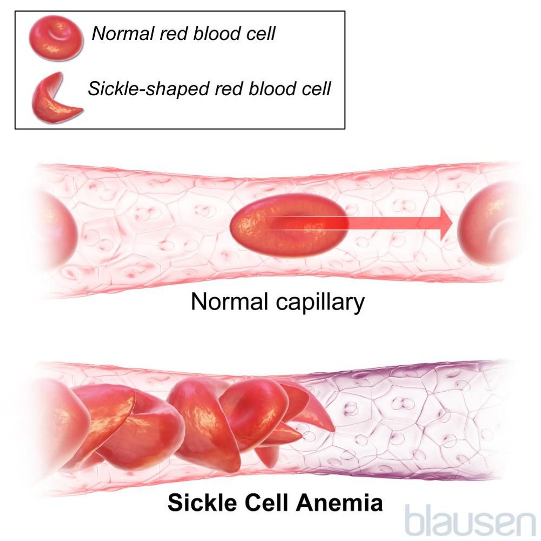 Anemia de células falciformes (anemia drepanocítica o drepanocitosis ...