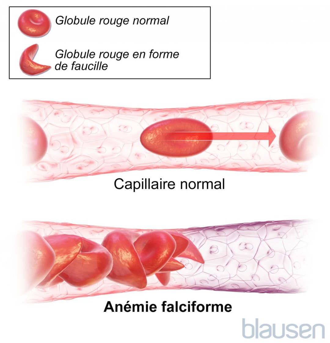 Les faits en bref:Drépanocytose - Manuels MSD pour le grand public