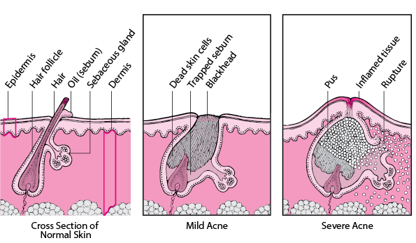 Acne - Skin Disorders - Merck Manual Consumer Version