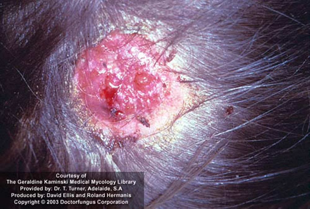 Scalp Ringworm (Tinea Capitis) - Skin Disorders - Merck Manual Consumer ...