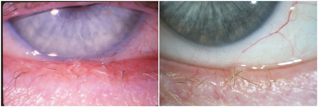 Trichiasis - Eye Disorders - Merck Manual Consumer Version