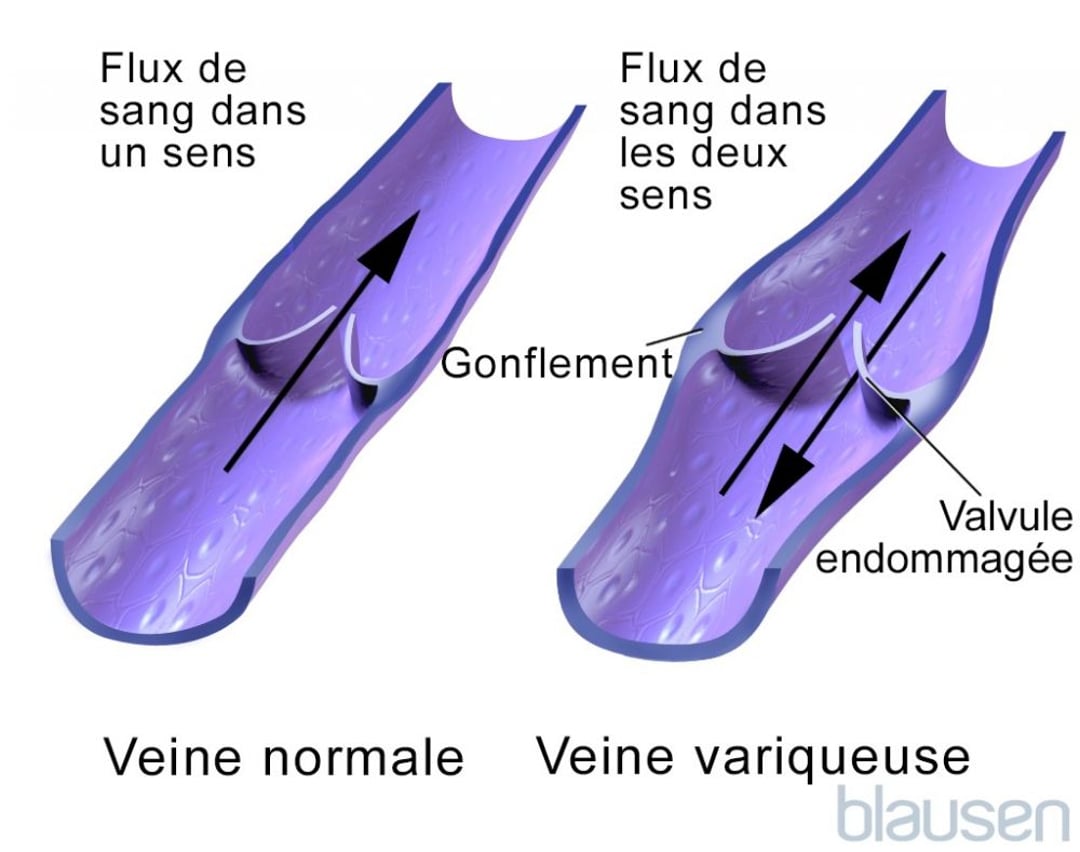 Varices - Troubles cardiaques et vasculaires - Manuels MSD pour le ...