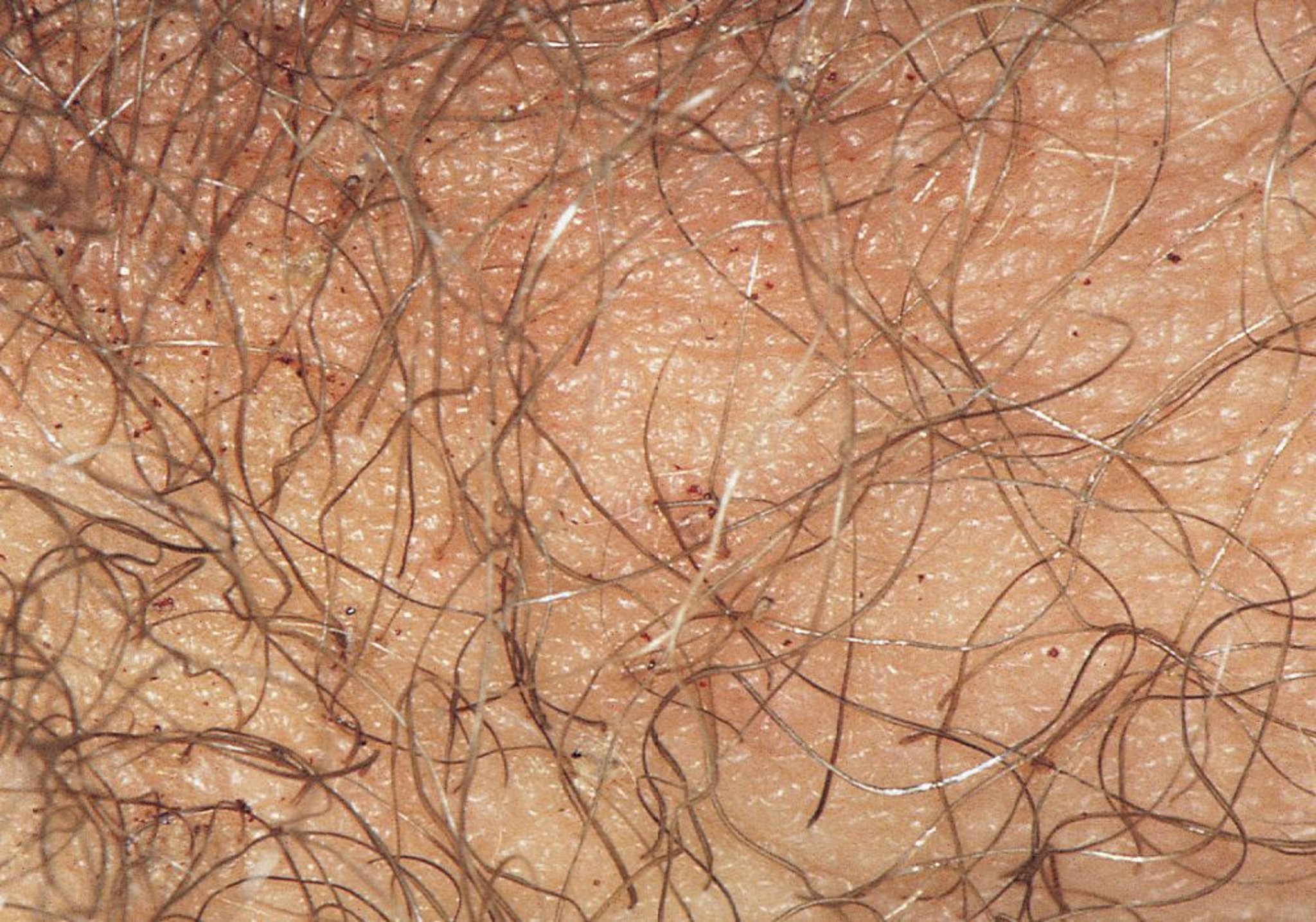 Image:Pediculosis pubis (Filzläuse) mit Läusekot-MSD Manual Profi-Ausgabe