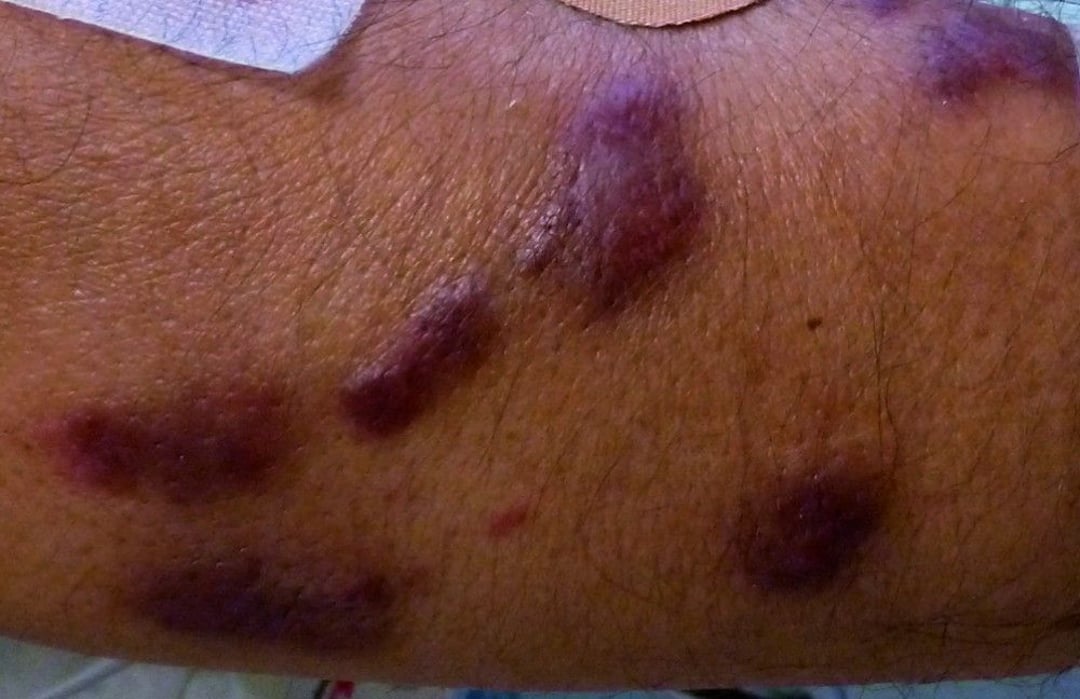 Kaposi Sarcoma - Dermatologic Disorders - Merck Manual Professional Edition