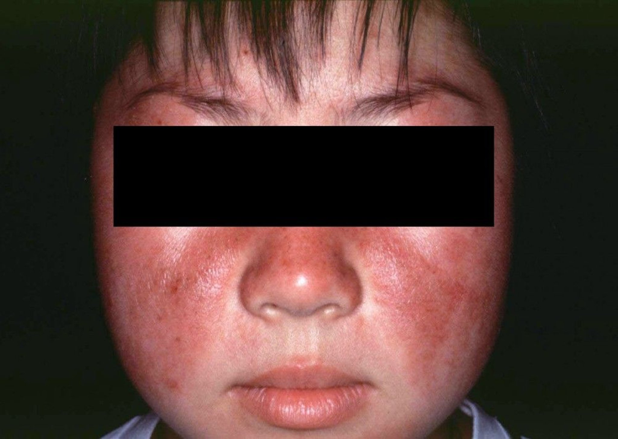Image:Systemic Lupus Erythematosus (Malar Rash)-Merck Manual ...
