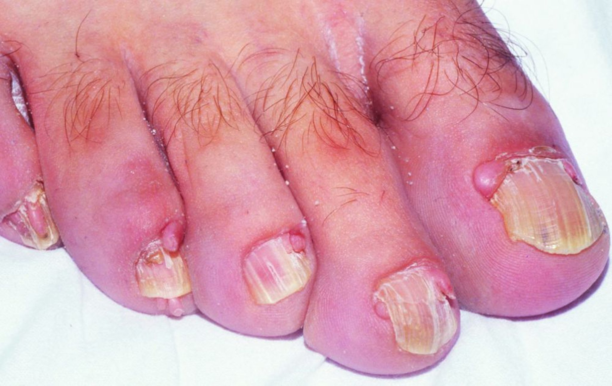 Image:结节性硬化症中的 Koenen 肿瘤-MSD诊疗手册专业版