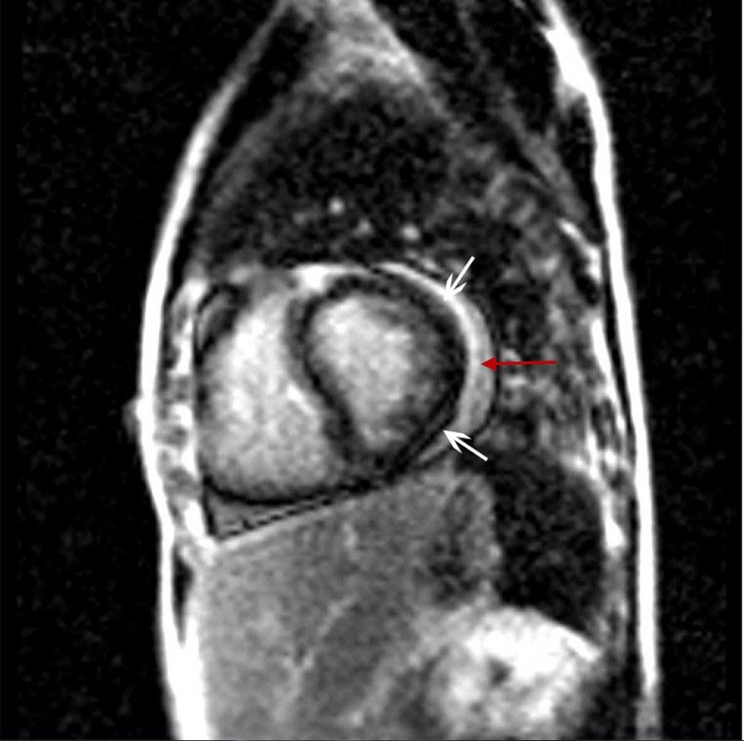 Image:MRI of Patient with Myocarditis and Pericardial Effusion-MSD Manual Professional Edition
