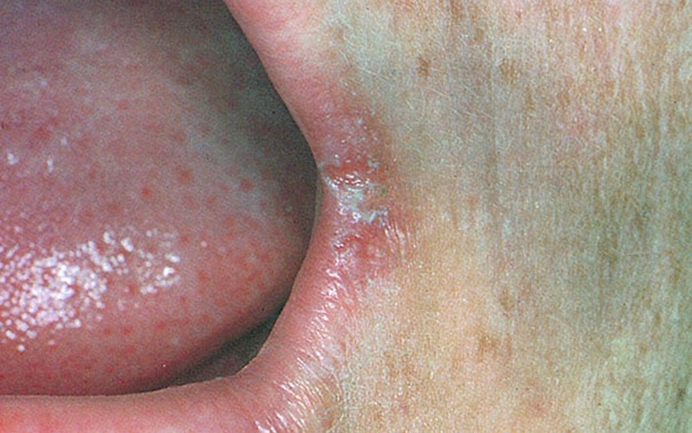 Lip Ulcers and Inflammation - Dentistry - Merck Manual Professional Edition