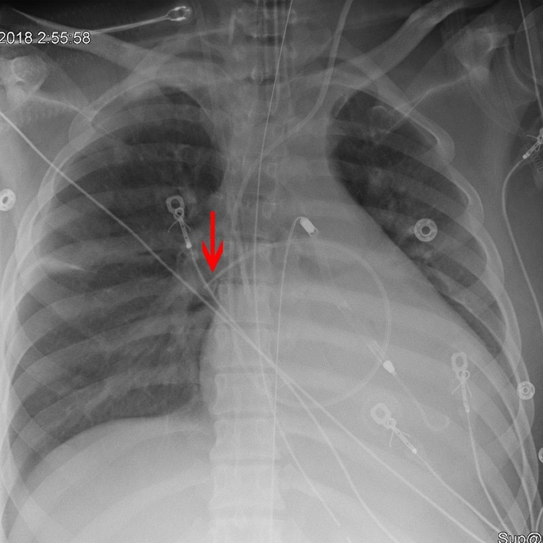 Image:Radiograph Showing Correct Placement of a Swan-Ganz Catheter-MSD ...
