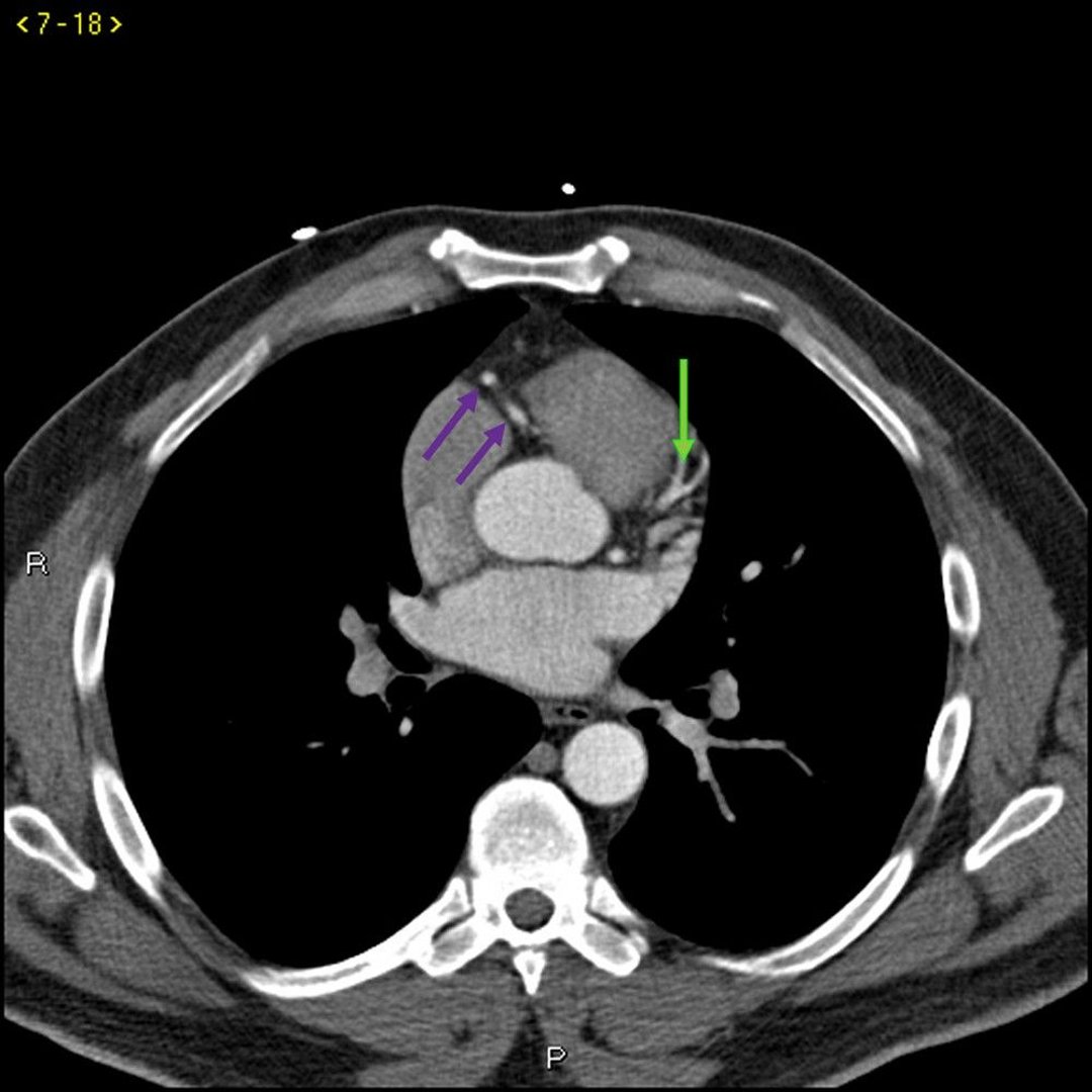 Image:Contrast CT Showing Normal Coronary Arteries – Slide 3-MSD Manual Professional Edition
