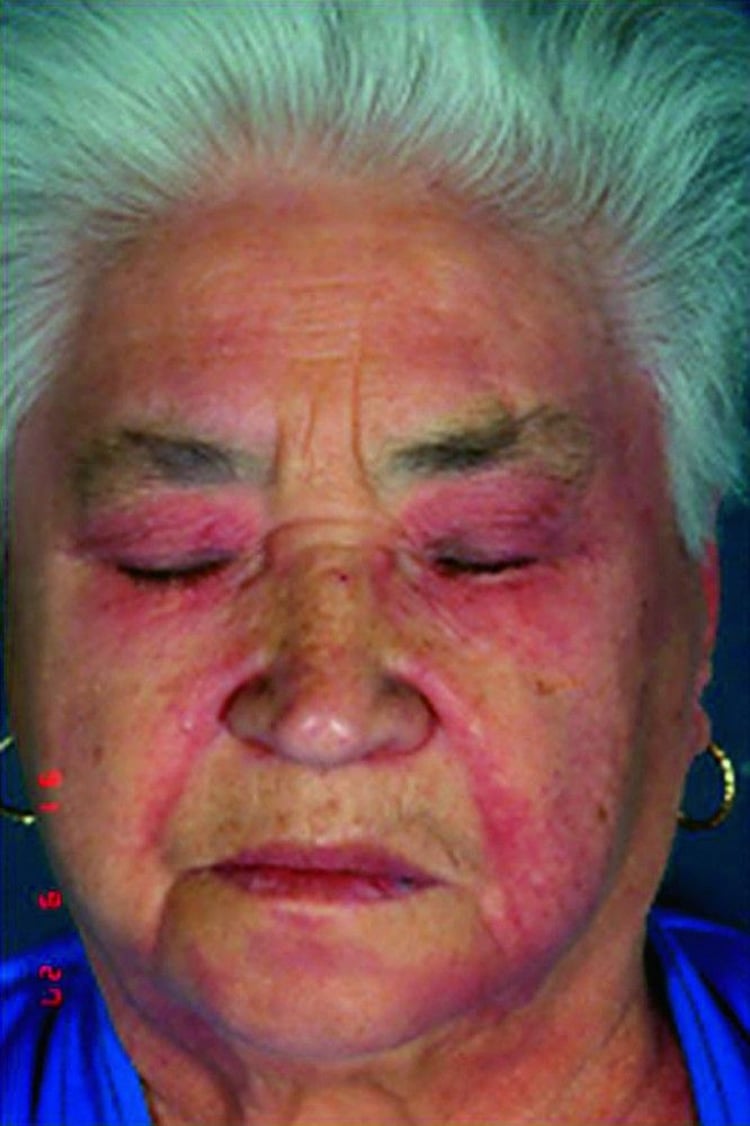 Paraneoplastic Syndromes - Hematology and Oncology - Merck Manual ...