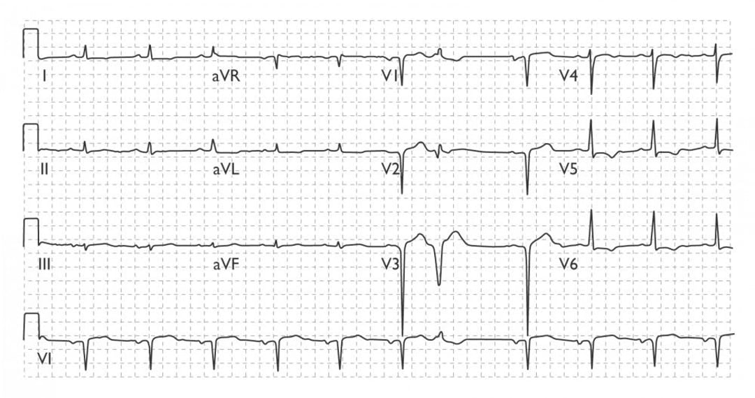 Ventricular Premature Beats (VPB) - Cardiovascular Disorders - MSD ...