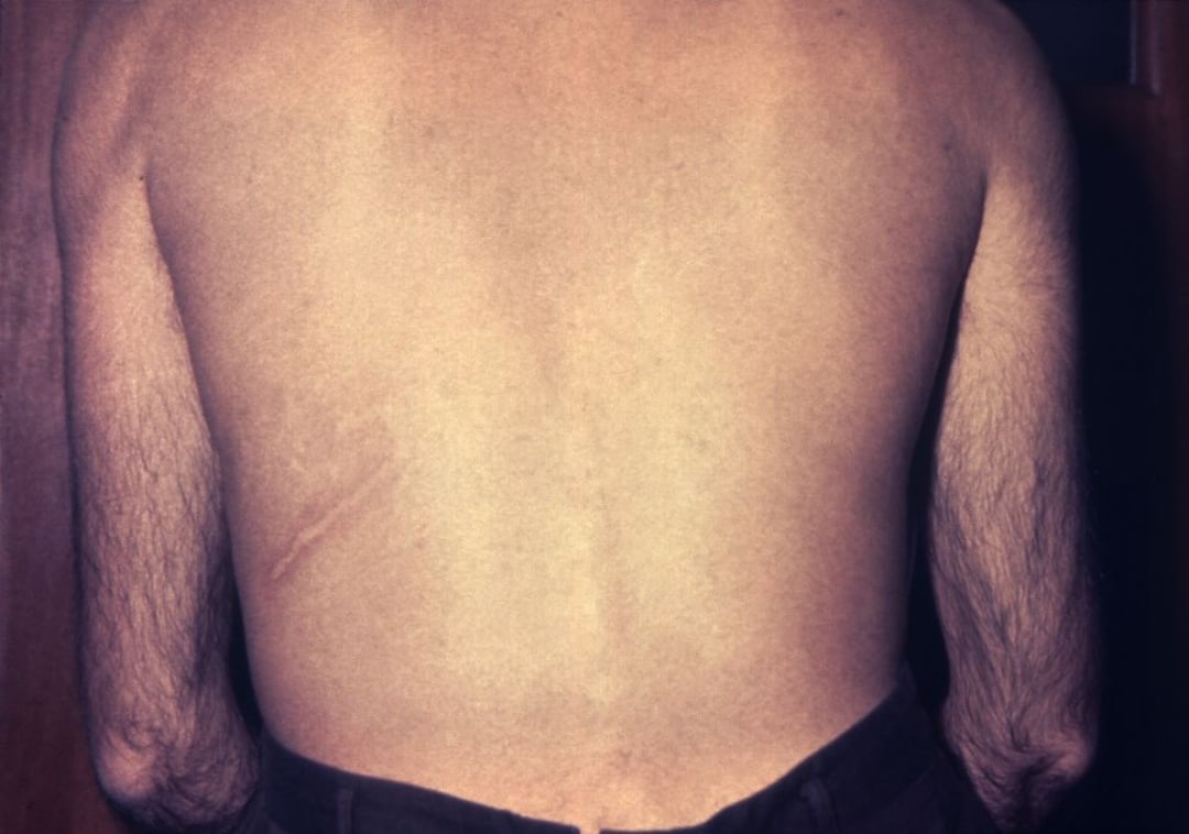 Estrongiloidiasis - Enfermedades infecciosas - Manual Merck versión ...