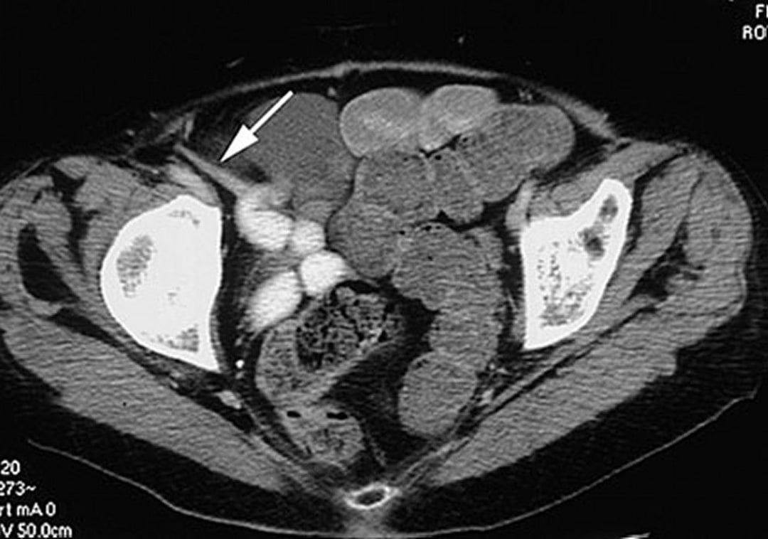 Image:Meckel Diverticulum (CT Scan)-MSD Manual Professional Edition