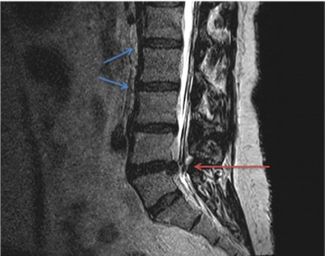 Lumbar Disc Herniation - Musculoskeletal and Connective Tissue ...