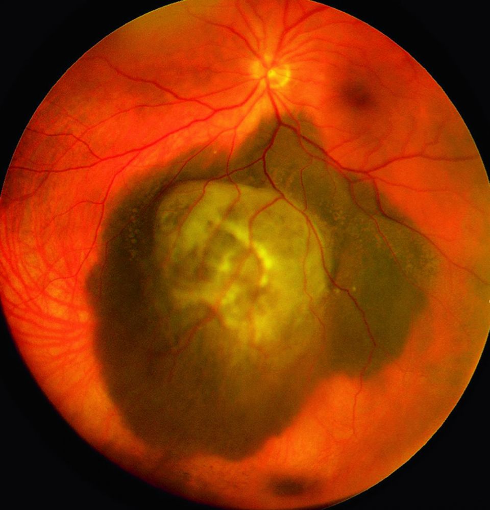 Cânceres que afetam a retina - Distúrbios oftalmológicos - Manuais MSD ...