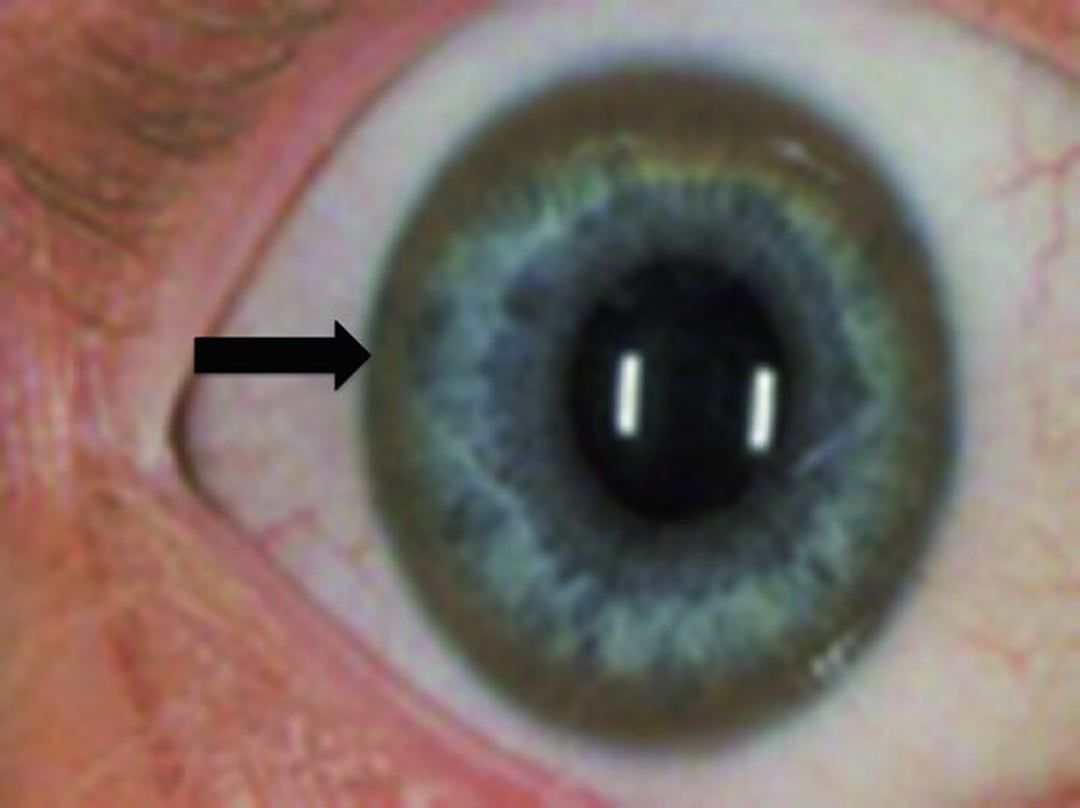 Wilson Disease - Nutritional Disorders - Merck Manual Professional Edition