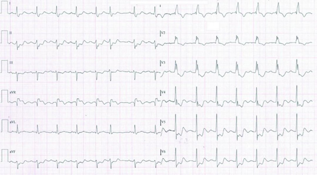 Infarctus du myocarde aigu - Cardiologie - Édition professionnelle du ...