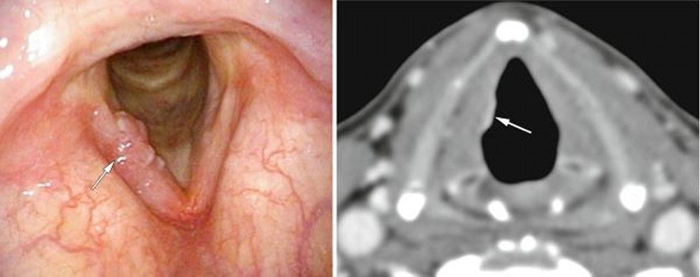 Laryngeal Cancer - Oncology - Merck Manual Professional Edition