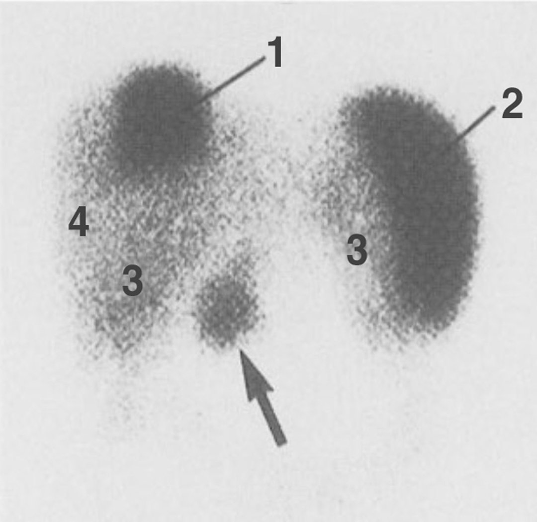 Image:Somatostatin Receptor Scintigraphy (Octreotide Scan) Showing ...