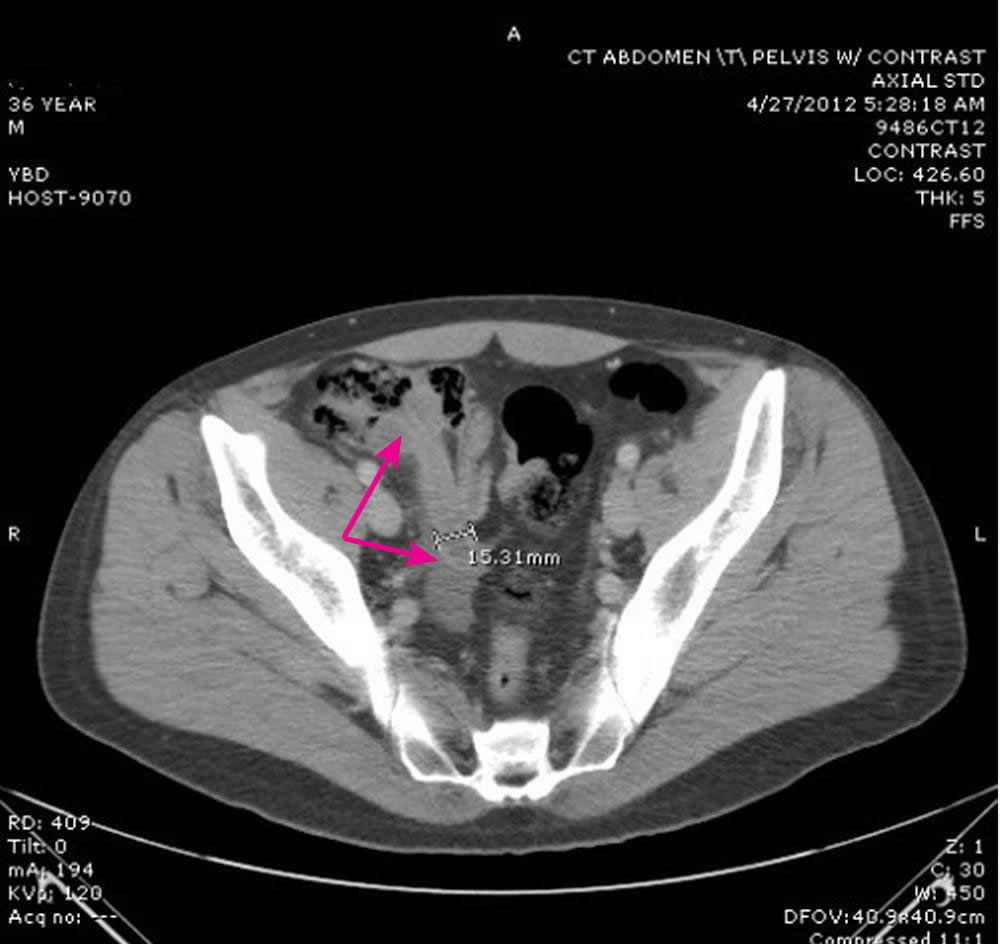Appendicite - Disturbi gastrointestinali - Manuali MSD Edizione ...