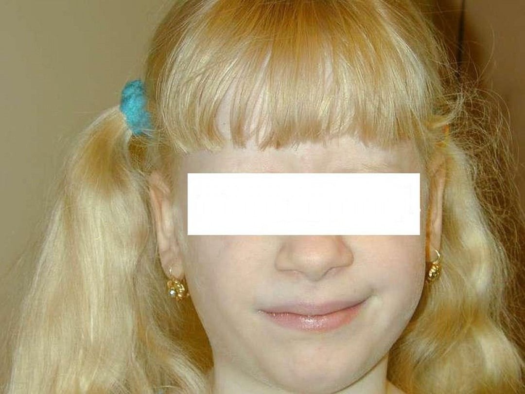 Albinism - Dermatology - MSD Manual Professional Edition