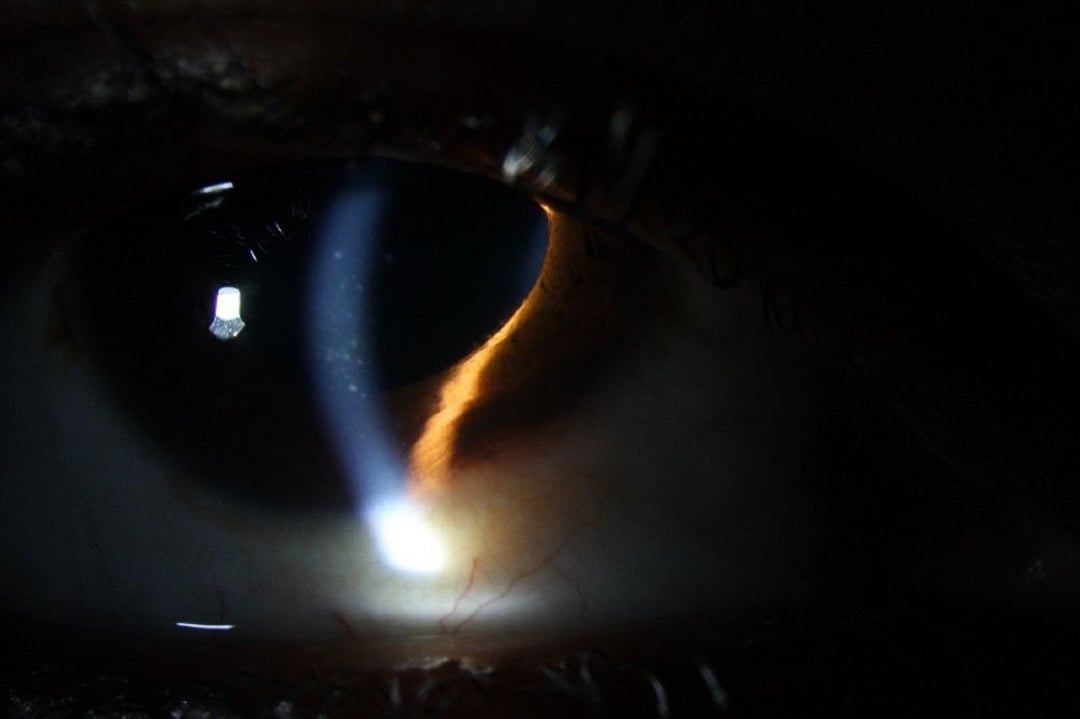 Overview of Uveitis - Eye Disorders - MSD Manual Professional Edition