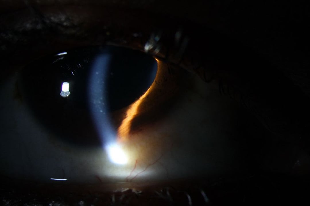 Überblick über Uveitis - Augenkrankheiten - MSD Manual Profi-Ausgabe