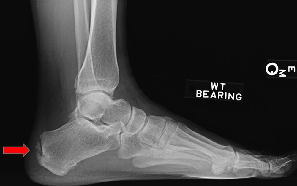 Achilles Tendon Enthesopathy - Musculoskeletal and Connective Tissue ...