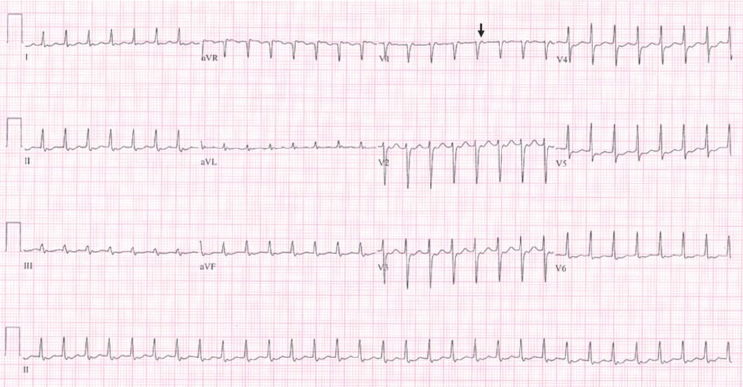 Reentrant (Paroxysmal) Supraventricular Tachycardias (PSVT) - Reentrant ...