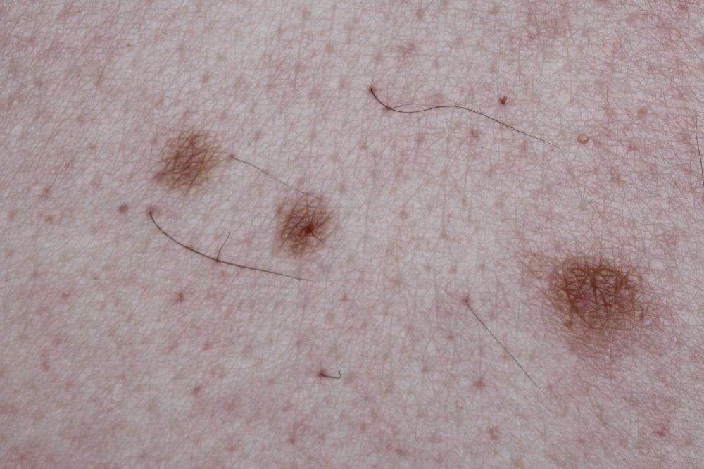 Nevi (Moles) - Dermatology - MSD Manual Professional Edition