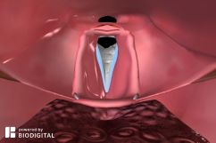 How To Do Flexible Laryngoscopy - Otolaryngology - MSD Manual ...