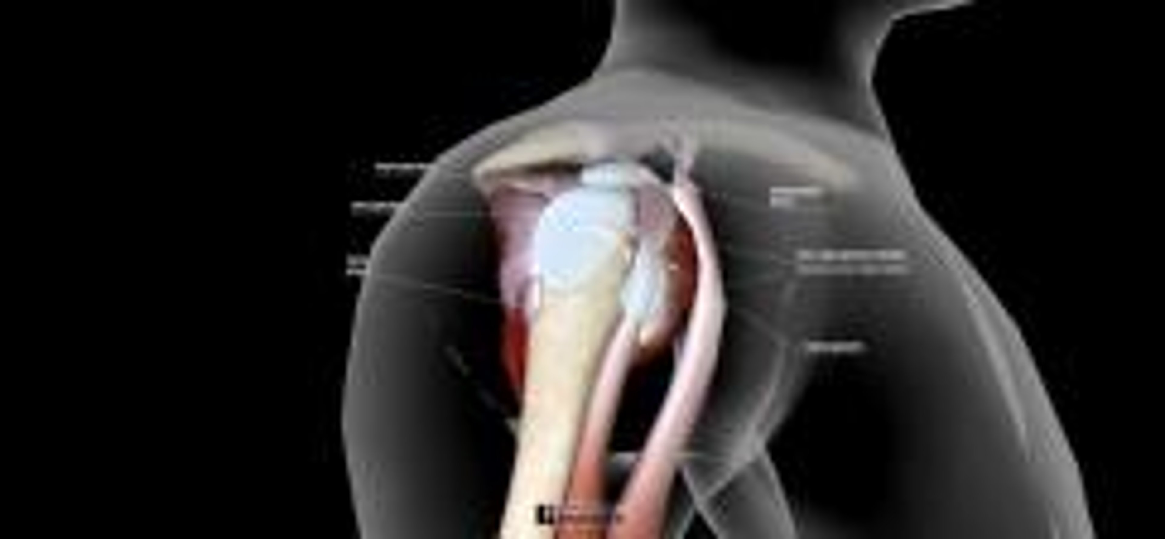 3D Model: Rotator Cuff Injury-Merck Manual Professional Edition