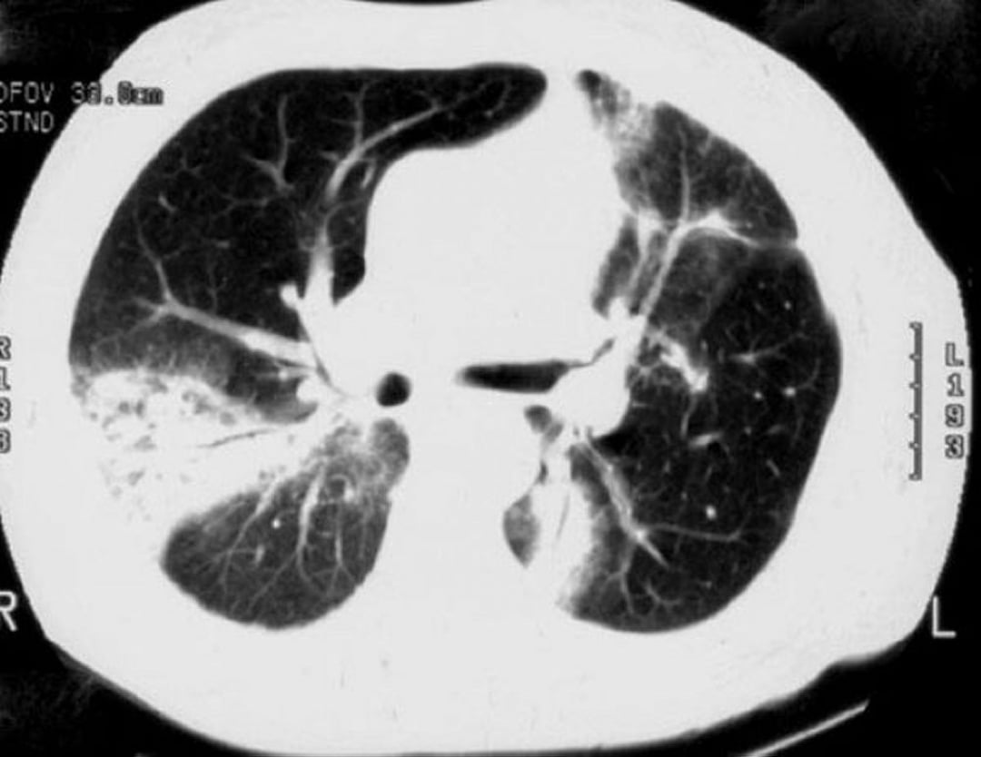 Cryptogenic Organizing Pneumonia (COP) - Pulmonary Disorders - MSD ...
