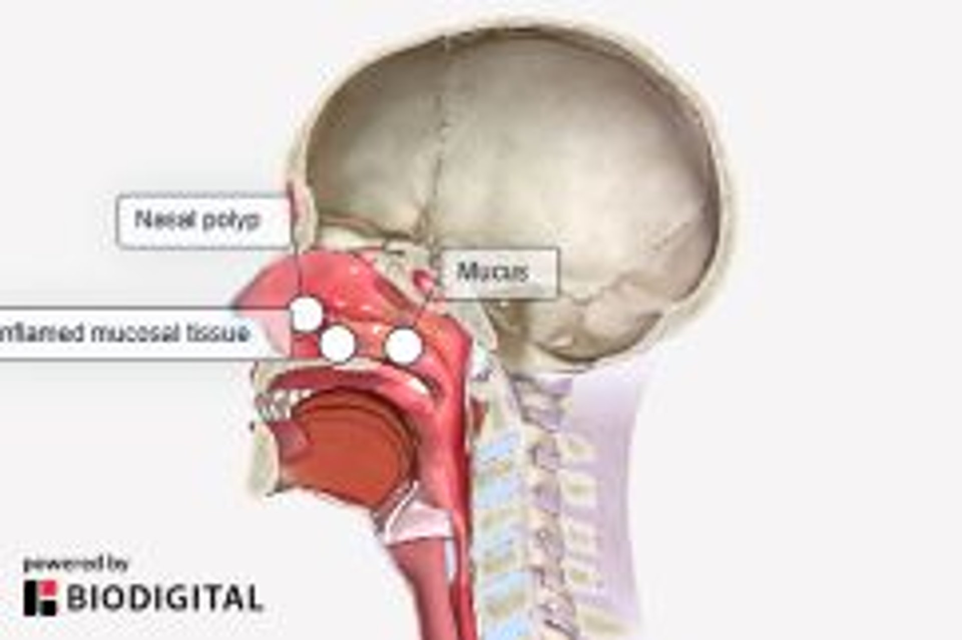 3D Model: Anatomy of Nasal Polyps-Merck Manual Professional Edition