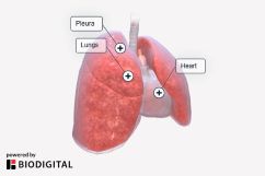 Comment effectuer une thoracentèse - Troubles pulmonaires - Édition ...