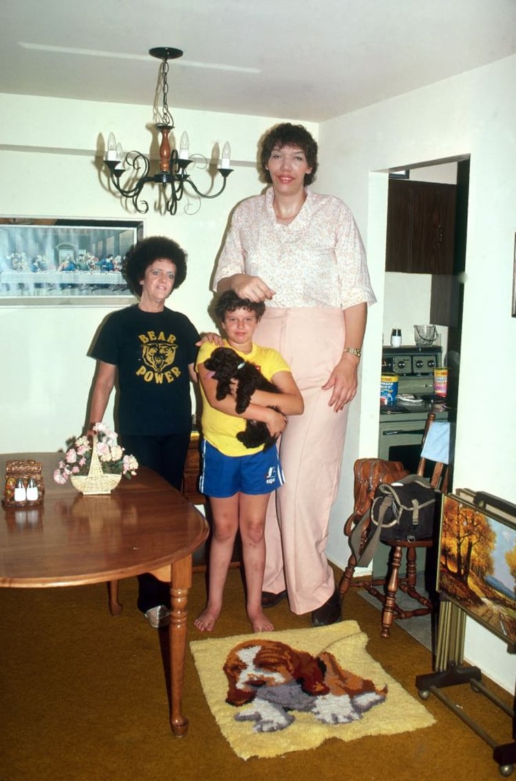 Gigantismus und Akromegalie - Endokrine und metabolische Krankheiten ...