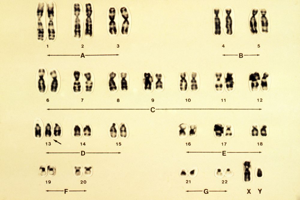 Trisomía 13 Pediatría Manual Msd Versión Para Profesionales