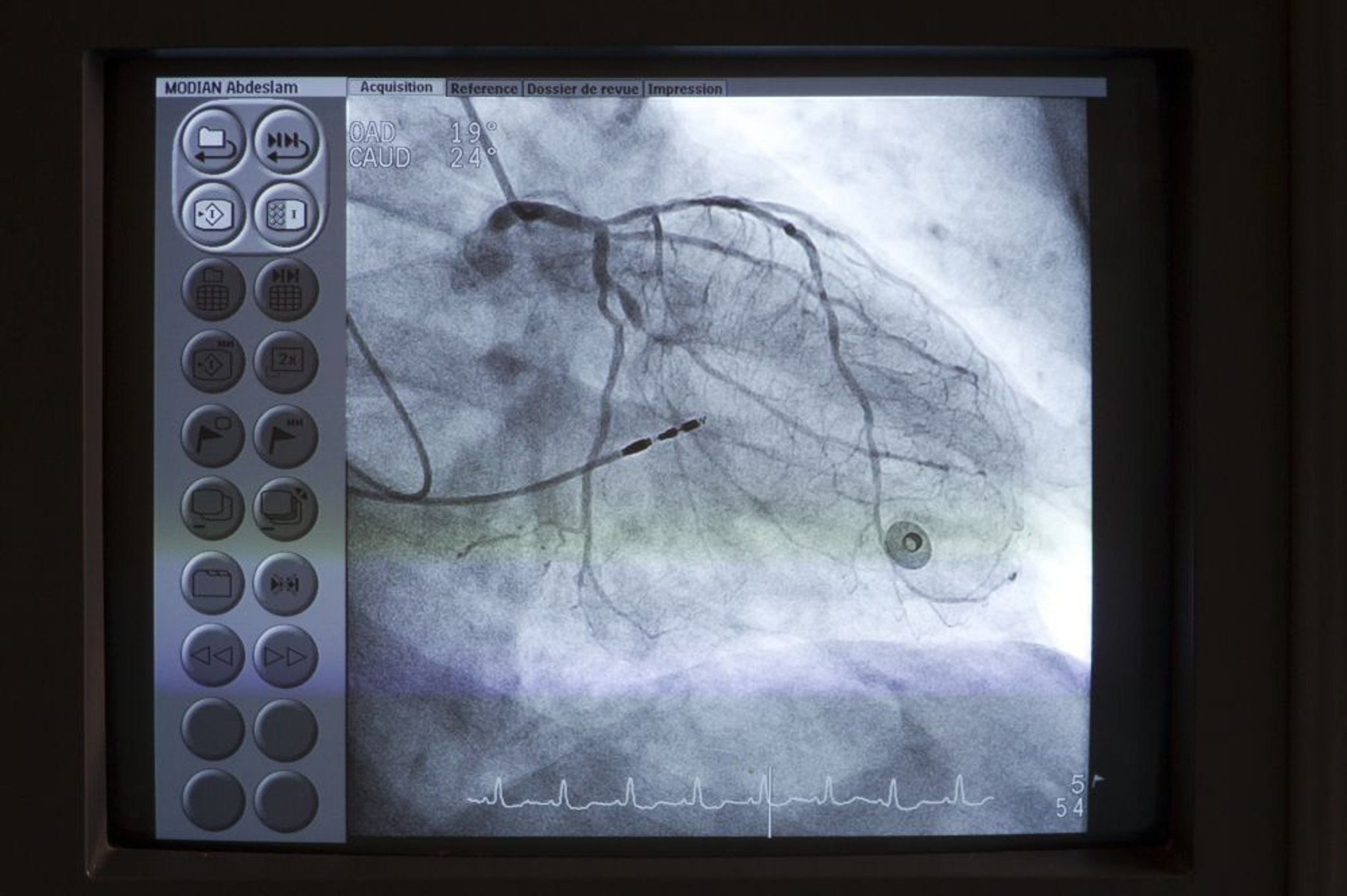 Image:Koronarangiographie-MSD Manual Profi-Ausgabe