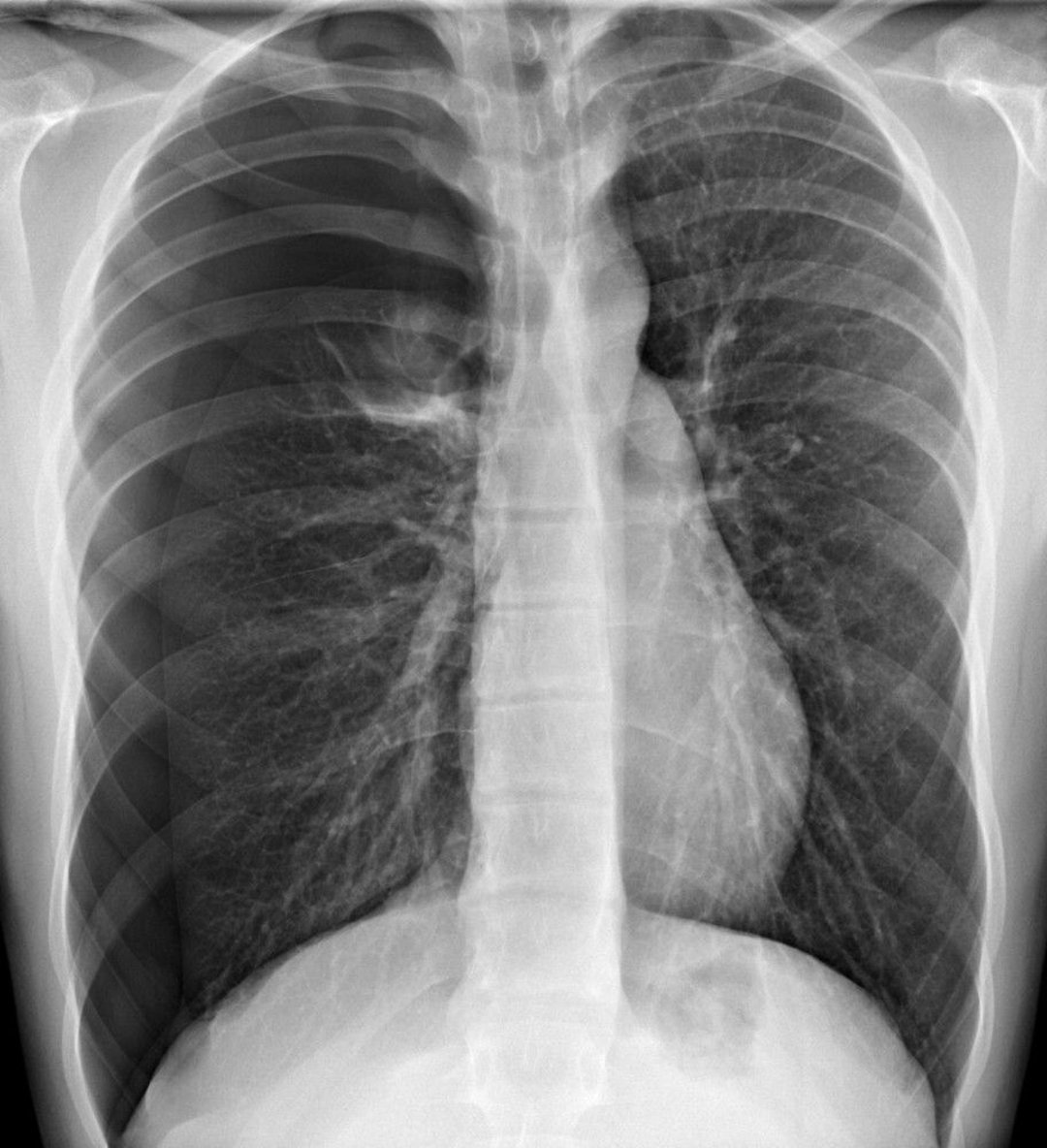 Pneumothorax - Pulmonology - MSD Manual Professional Edition
