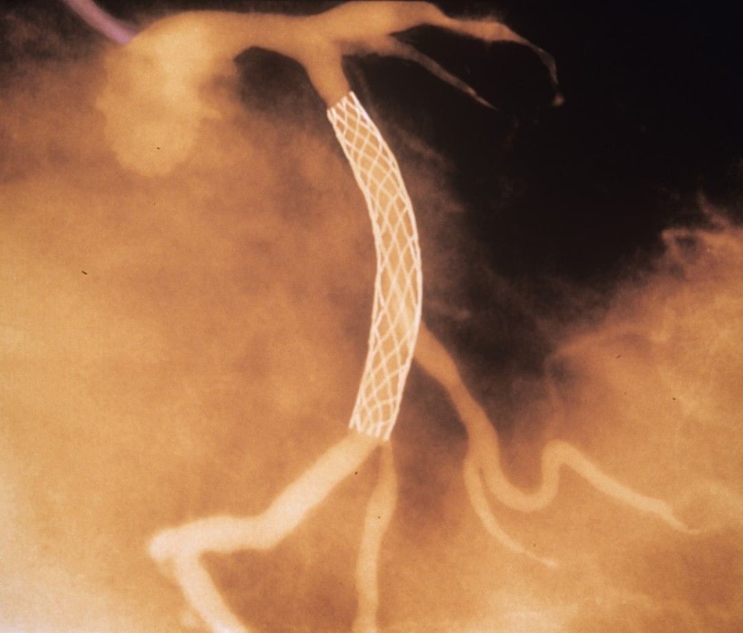 Intervenções coronarianas percutâneas (ICP) - Doenças cardiovasculares ...